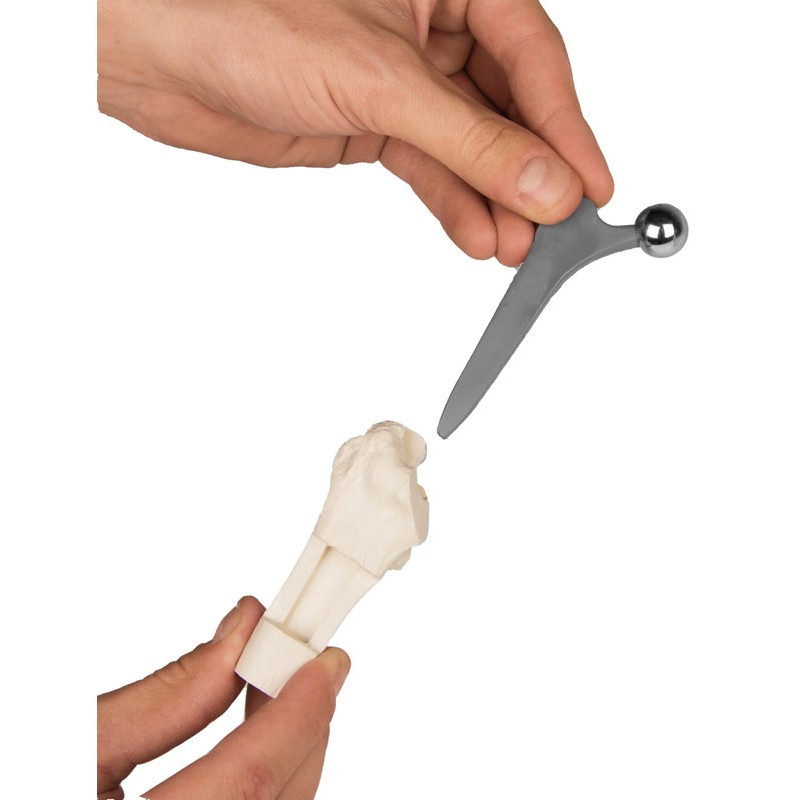 Hip Implant Model | Health and Care